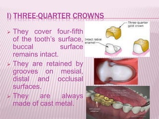 Types of crown & bridges | PPT