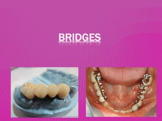 Types of crown & bridges | PPT