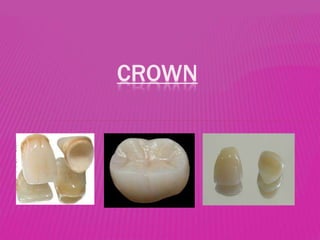 Types of crown & bridges | PPT