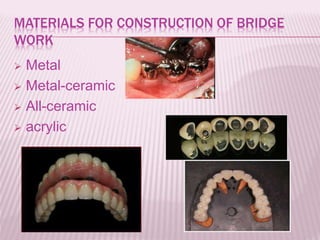 Types of crown & bridges | PPT