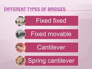 Types of crown & bridges | PPT