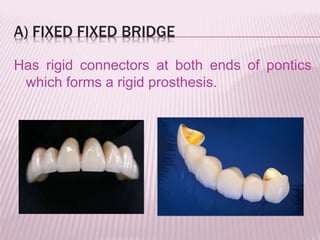 Types of crown & bridges | PPT