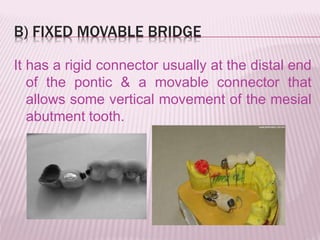 Types of crown & bridges | PPT