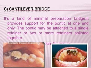 Spring Cantilever Bridge Dental