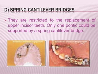 Types of crown & bridges | PPT