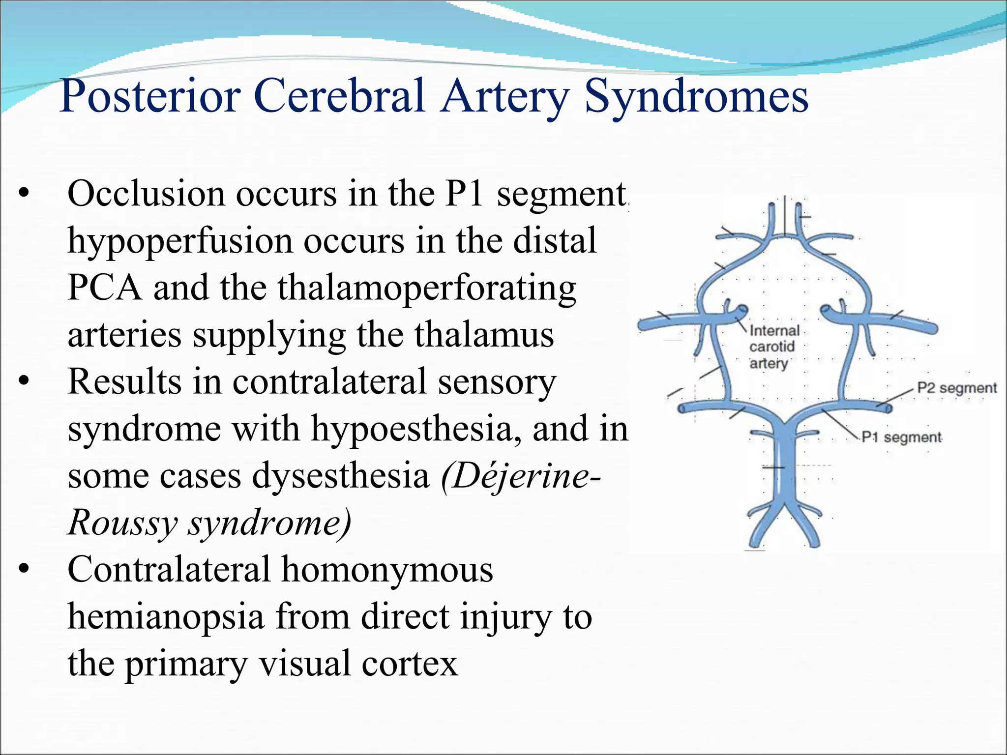 Types of cva and stroke syndromes | PPTX