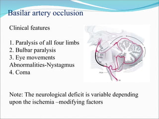 Types of cva and stroke syndromes | PPTX