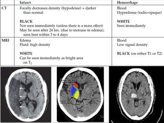 Types of cva and stroke syndromes | PPTX