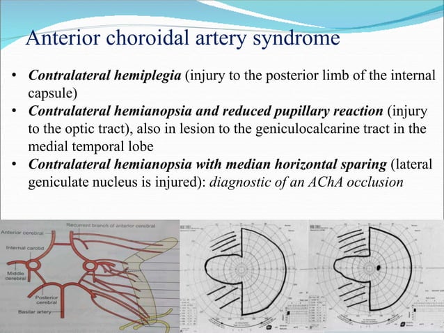 Types of cva and stroke syndromes
