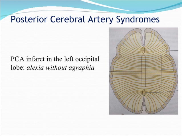 Types of cva and stroke syndromes