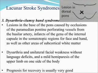 Types of cva and stroke syndromes | PPT