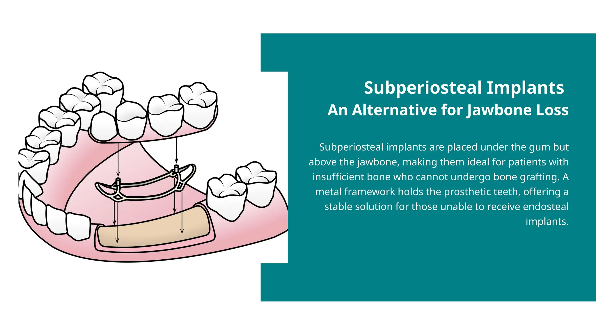 Types of Dental Implants - Choosing the Right Option for You.pptx
