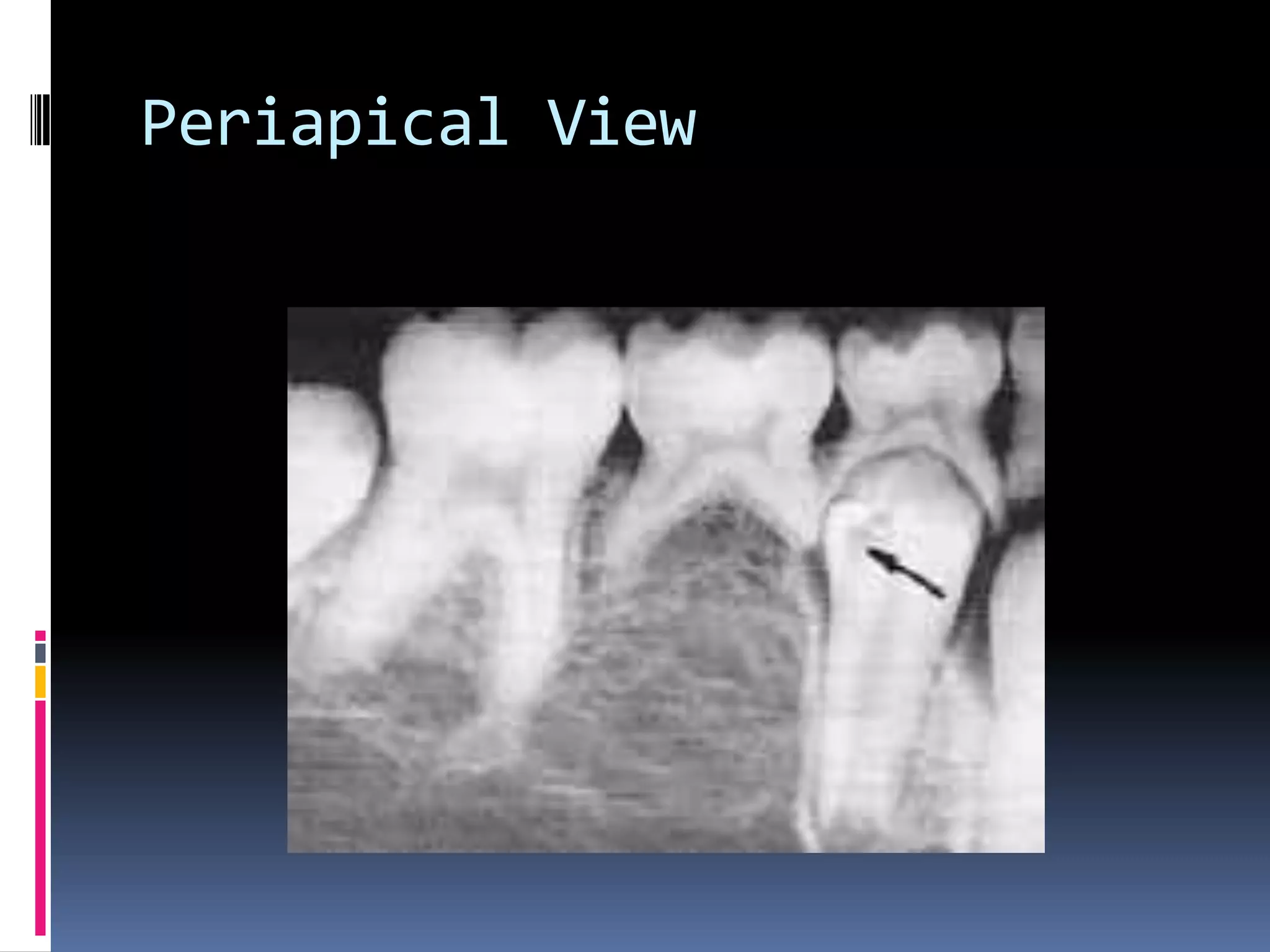 Types of dental radiographs in children | PPTX