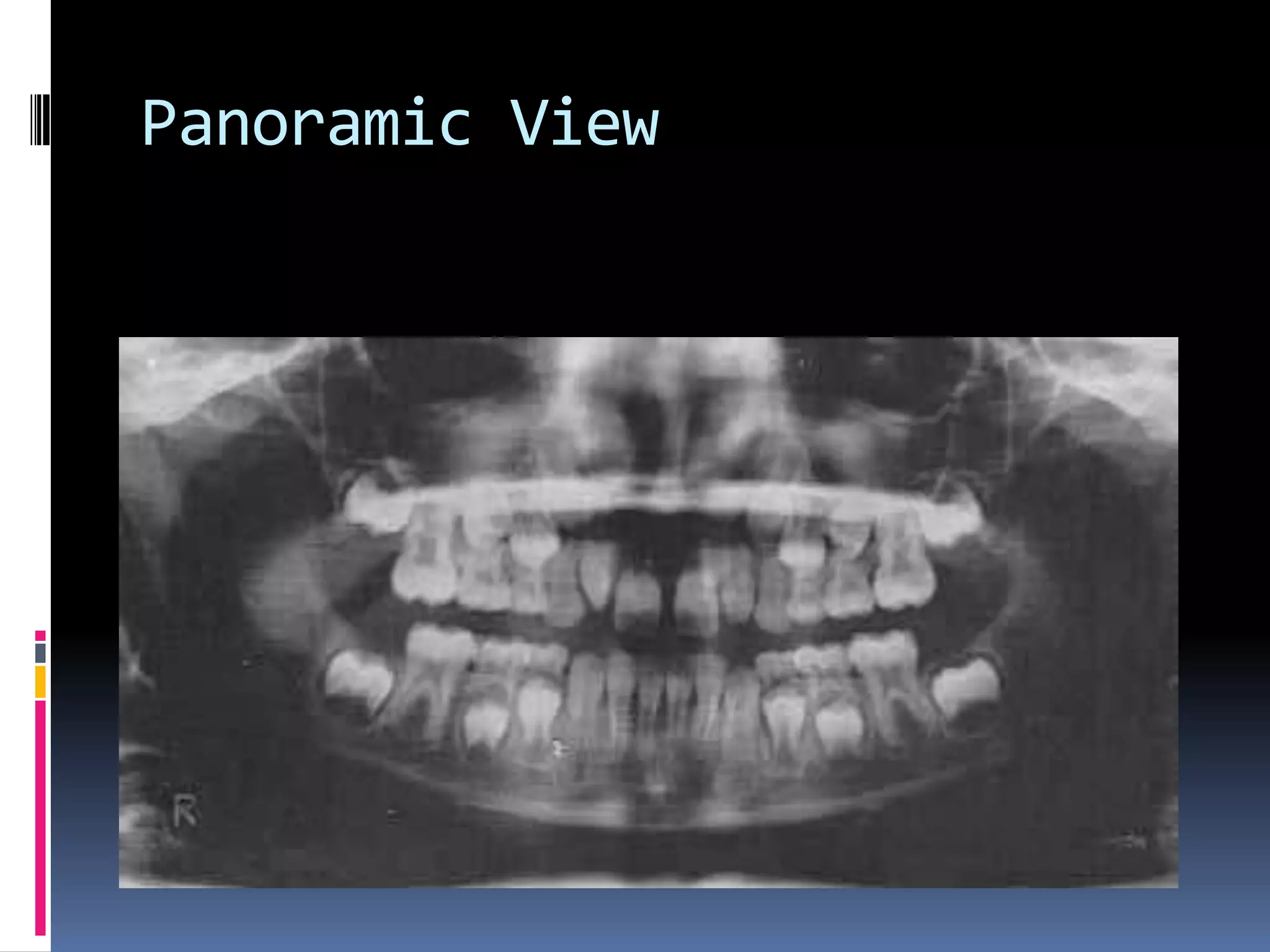 Types of dental radiographs in children | PPTX