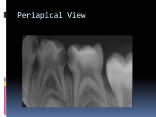 Types of dental radiographs in children | PPTX