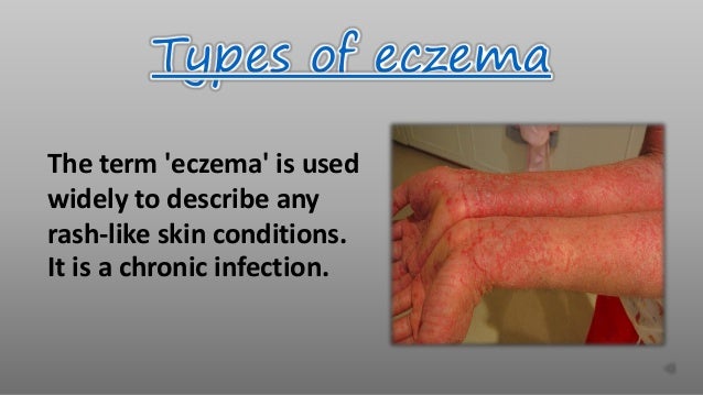 Types of eczema