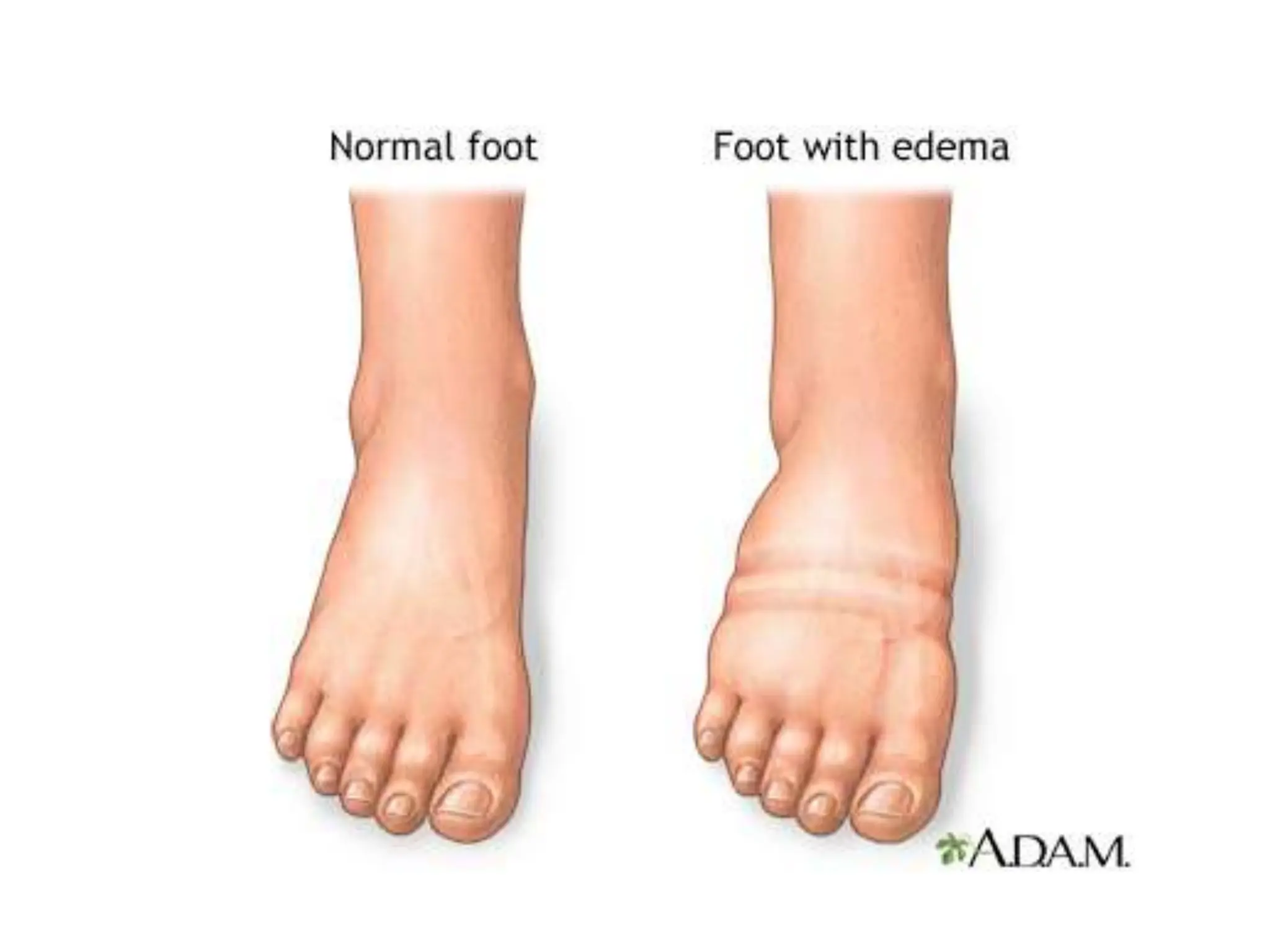 Types of EDEMA-28,30,38.pptxuvgvvugvbhbhbh hjb | PPTX