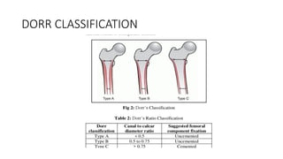 TYPES OF FEMORAL STEMS.pptx muse know for THR | PPTX