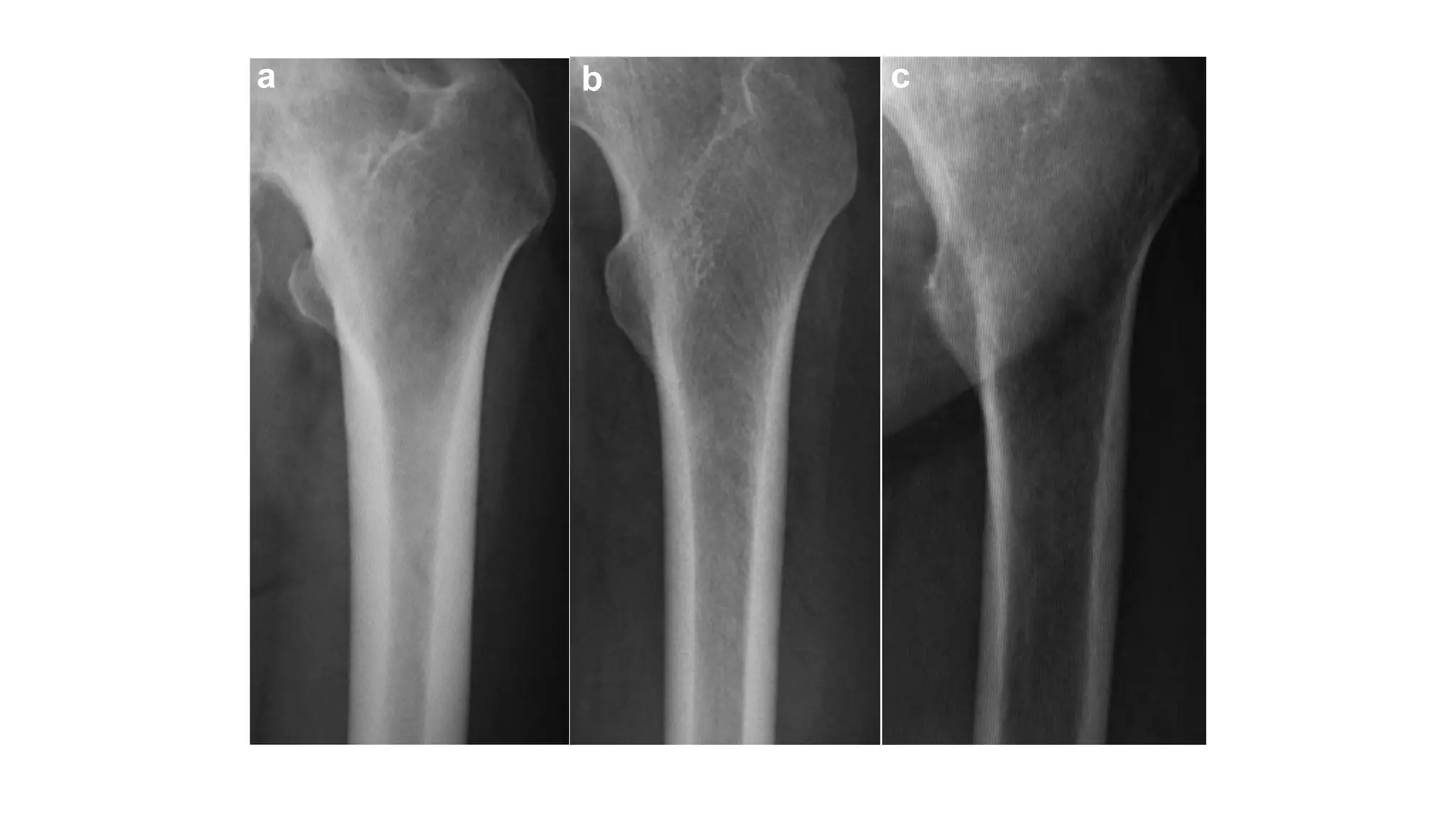 TYPES OF FEMORAL STEMS.pptx for arthropoasty | PPT