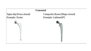 TYPES OF FEMORAL STEMS.pptx for arthropoasty | PPT