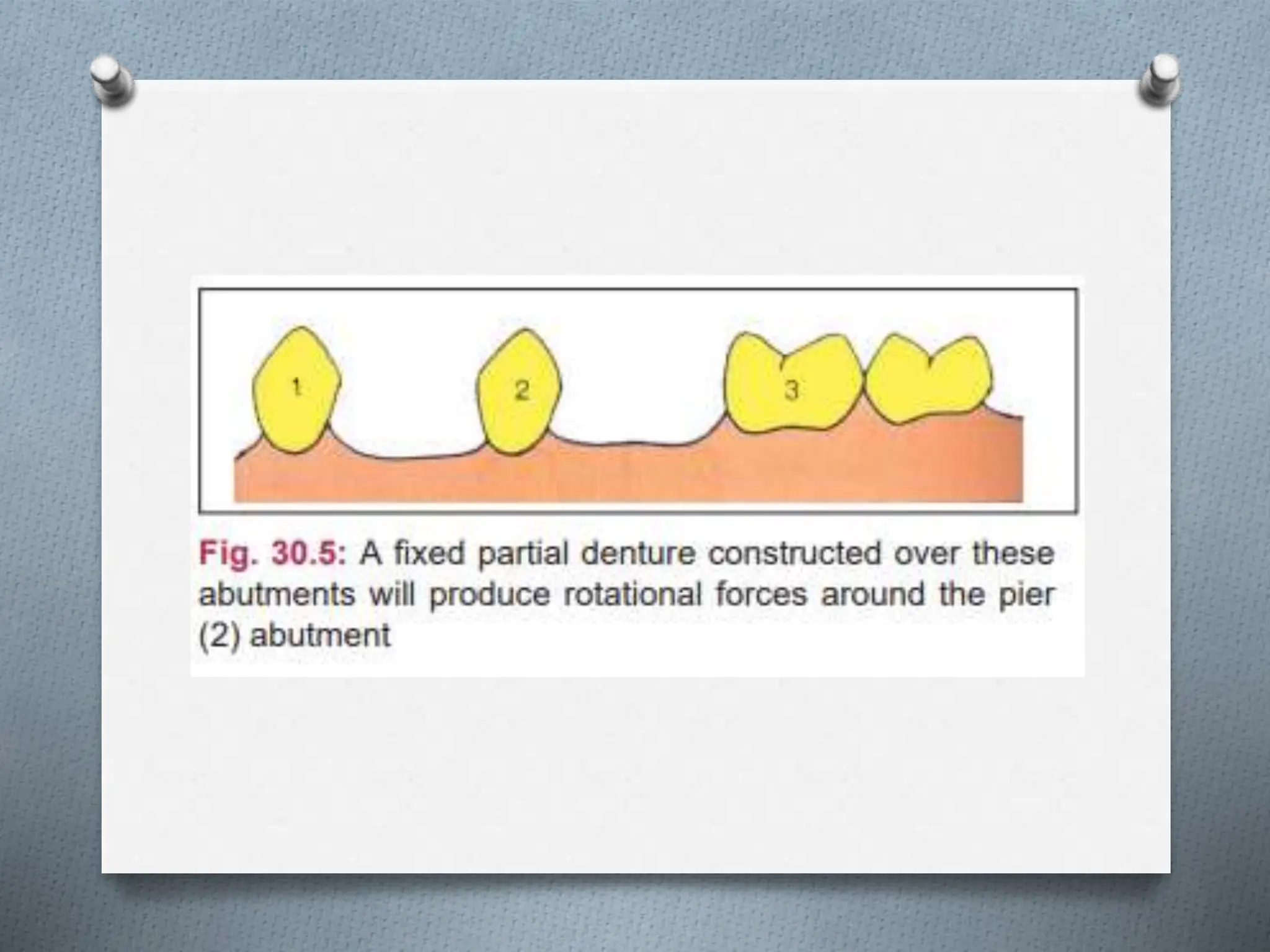 Types of Fixed Partial Dentures for BDS. | PPTX