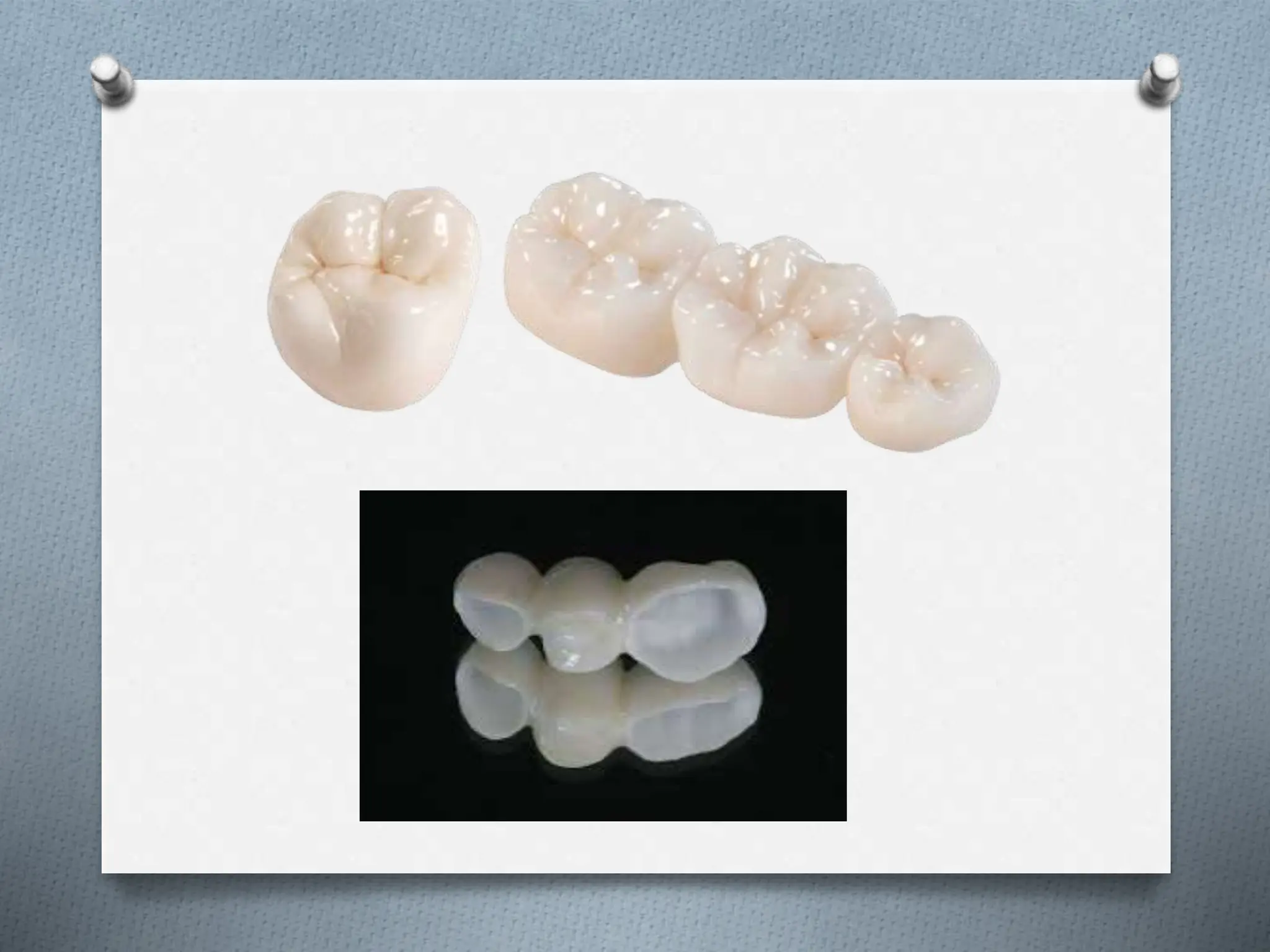 Types of Fixed Partial Dentures for BDS. | PPTX