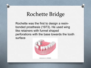 Types of Fixed Partial Dentures for BDS. | PPTX