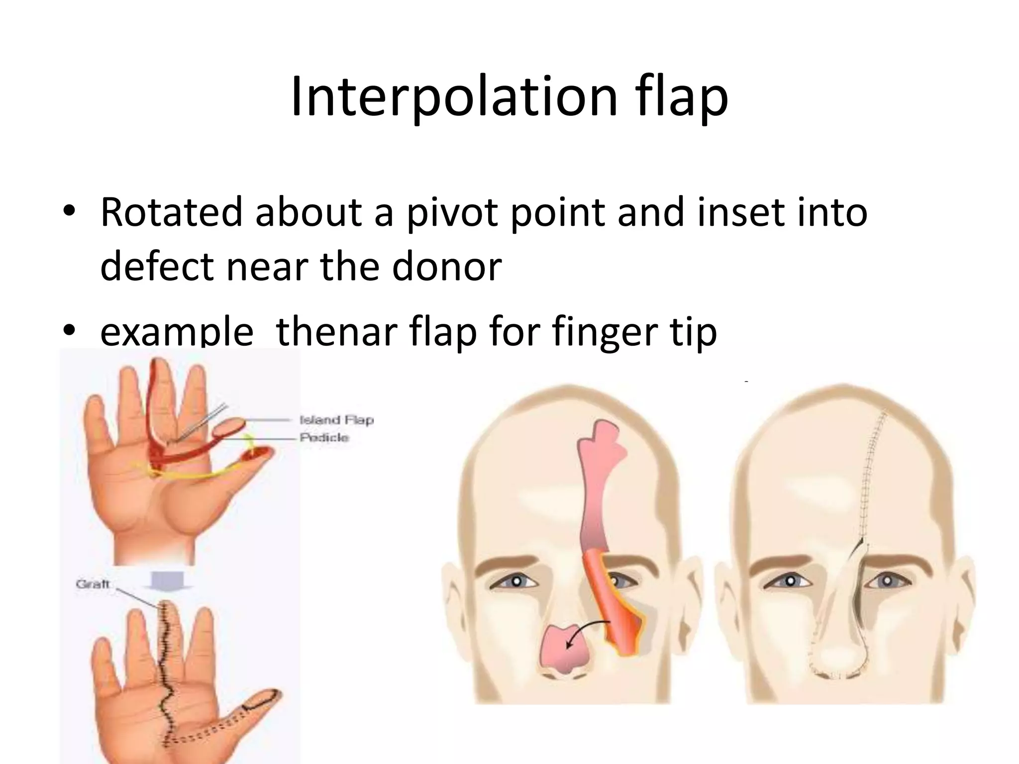 Types Of Flap Ppt