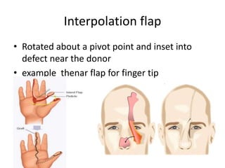 Types of flap | PPTX