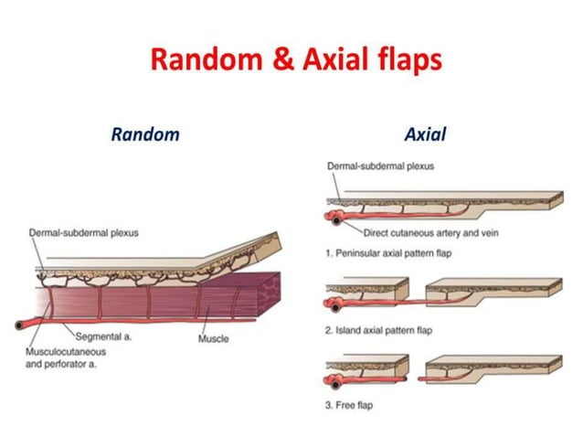 Types of flap | PPTX