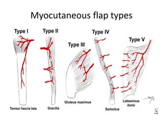 Types of flap | PPTX