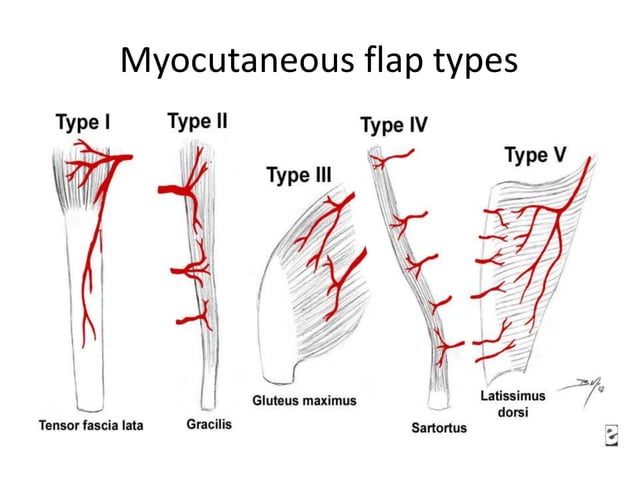 Types of flap | PPTX