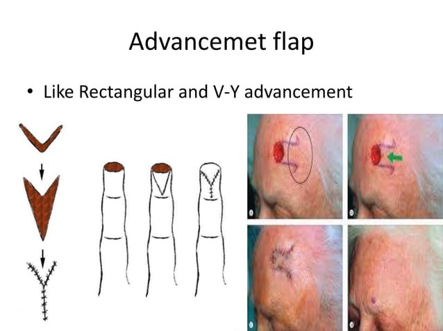 Types of flap | PPTX