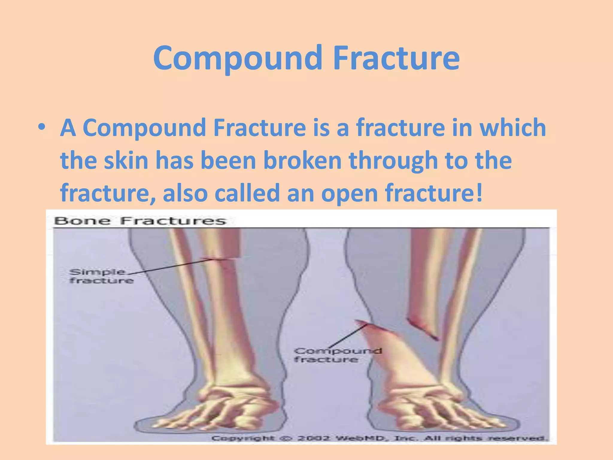 Types Of Fractures | PPTX | Death, Injury, or Military Conflict ...