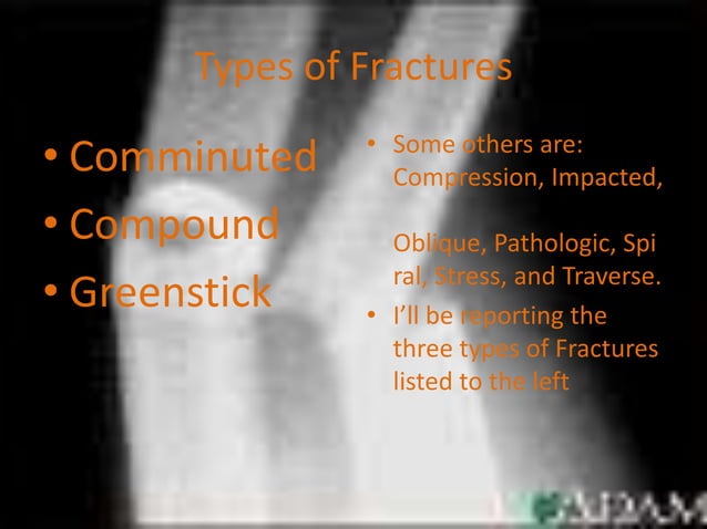Types Of Fractures | PPTX | Death, Injury, or Military Conflict ...