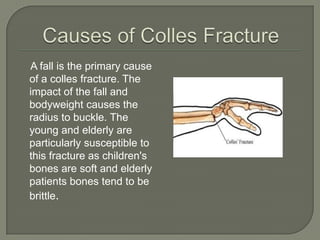 Types Of Fractures | PPTX