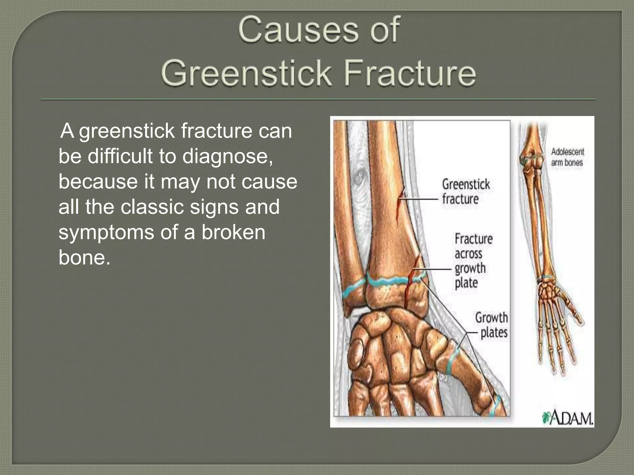Types Of Fractures | PPTX