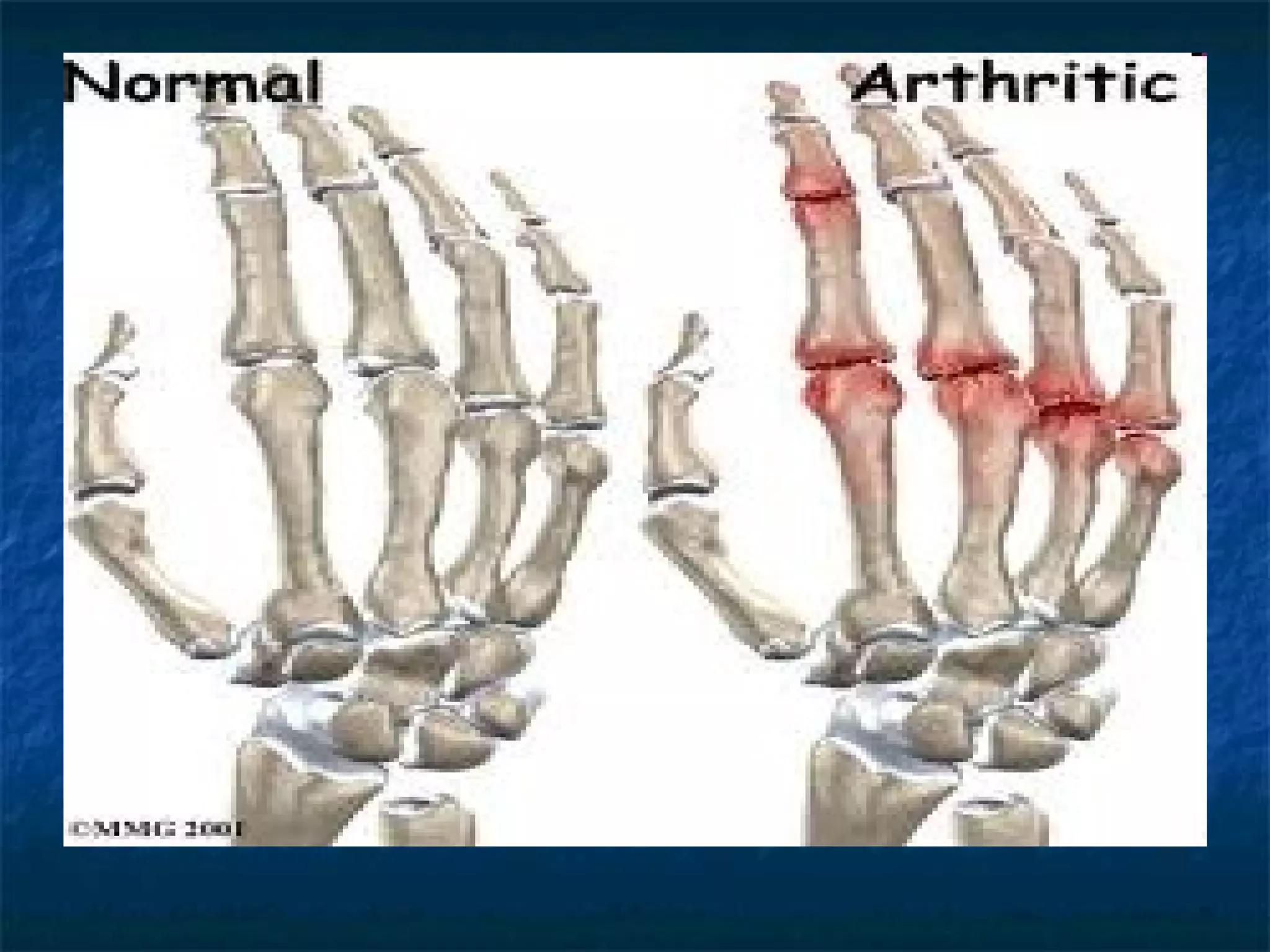 common diseases/disorders of the skeletal system | PPT