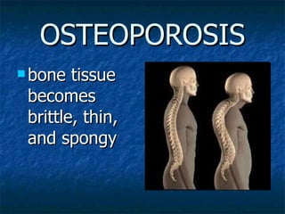 common diseases/disorders of the skeletal system | PPT