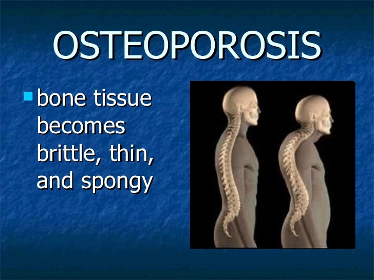 Common Diseases Of The Skeletal System Common Diseases Of The Skeletal System
