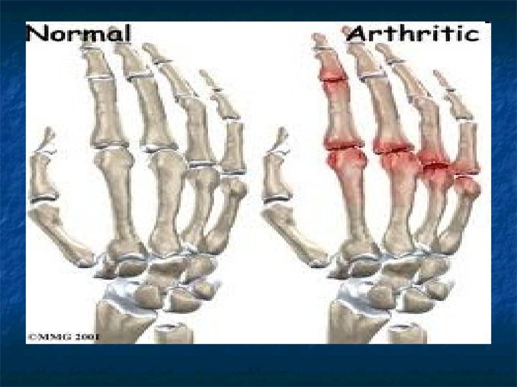 Common Diseases disorders Of The Skeletal System