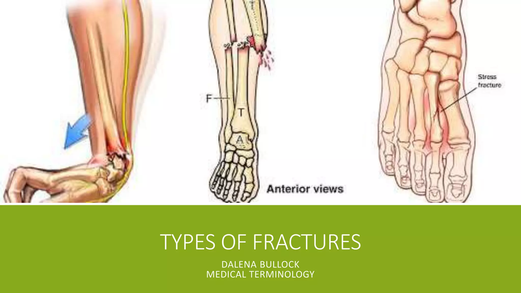 Types of fractures | PPTX