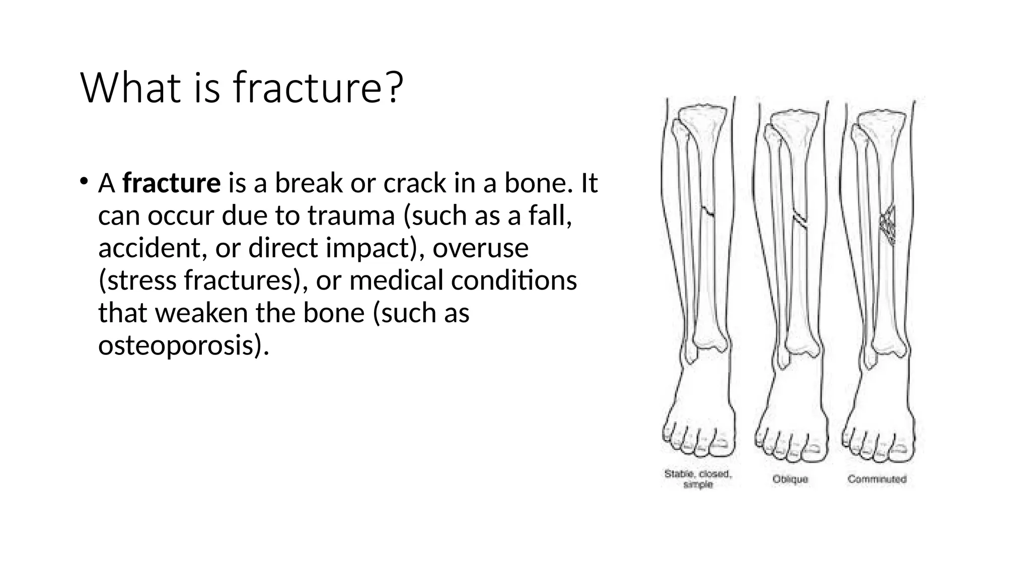 TYPES OF FRACTURES.pptx- shubhashis mondal | PPTX