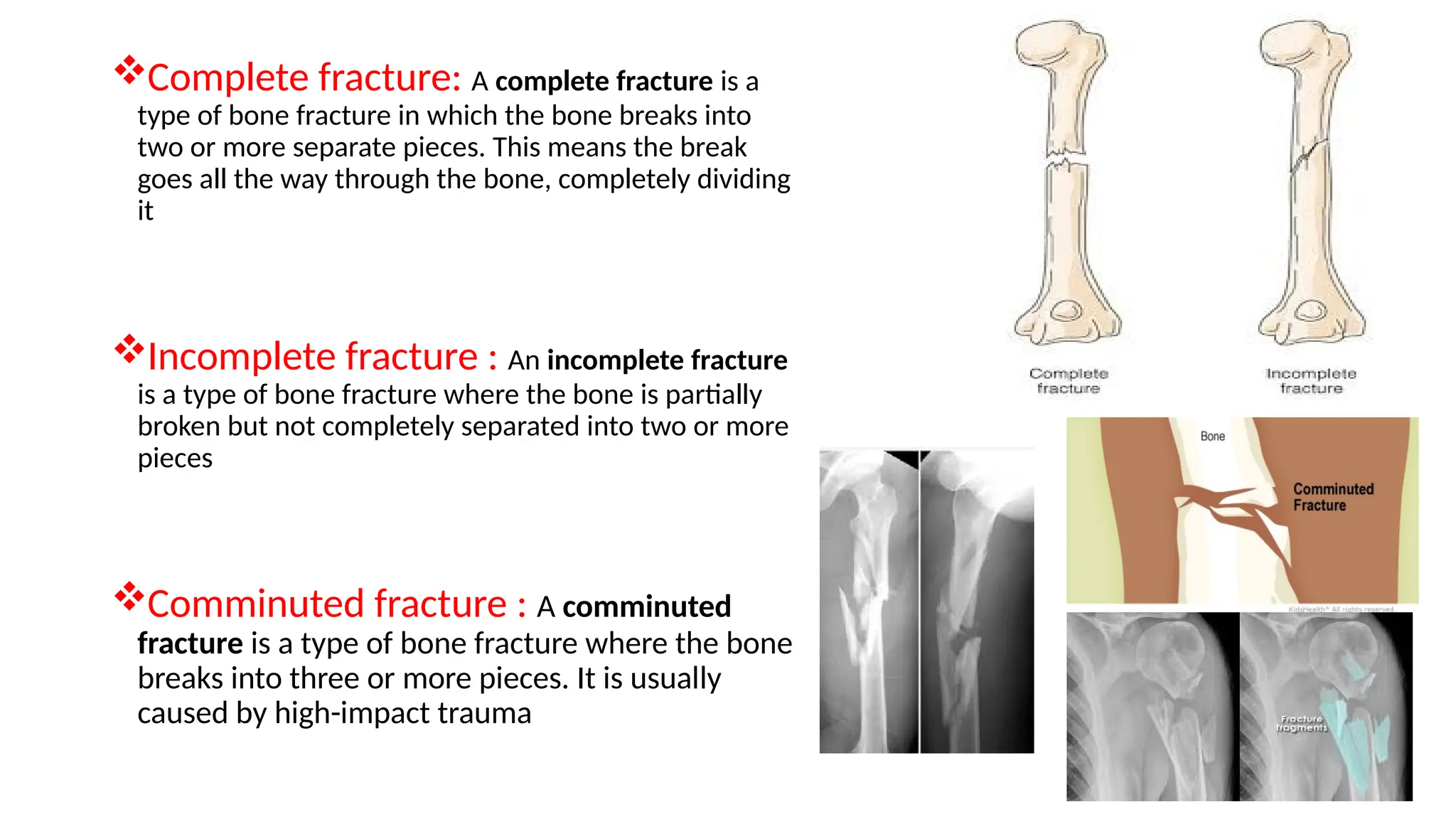 TYPES OF FRACTURES.pptx- shubhashis mondal | PPTX