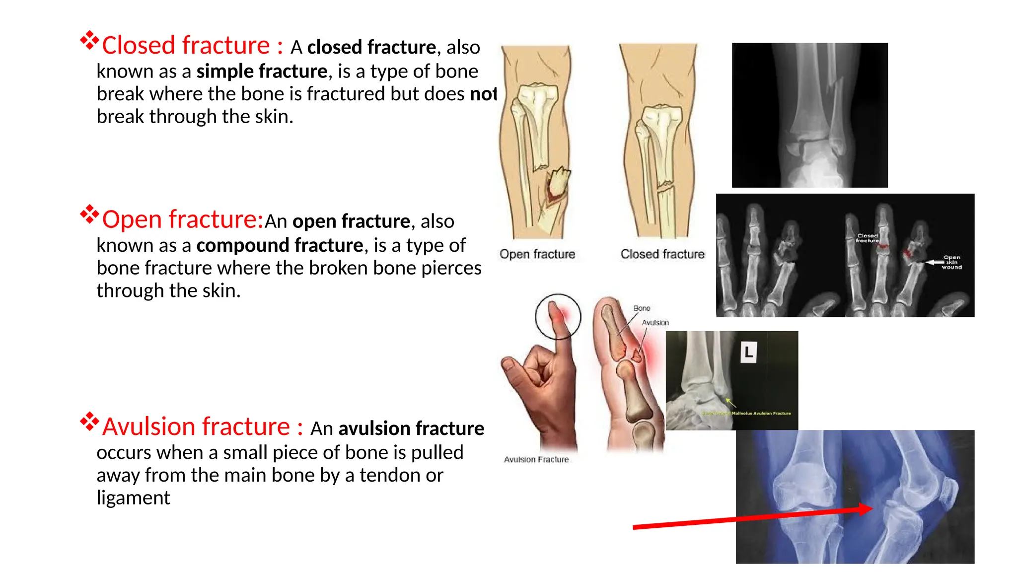 TYPES OF FRACTURES.pptx- shubhashis mondal | PPTX