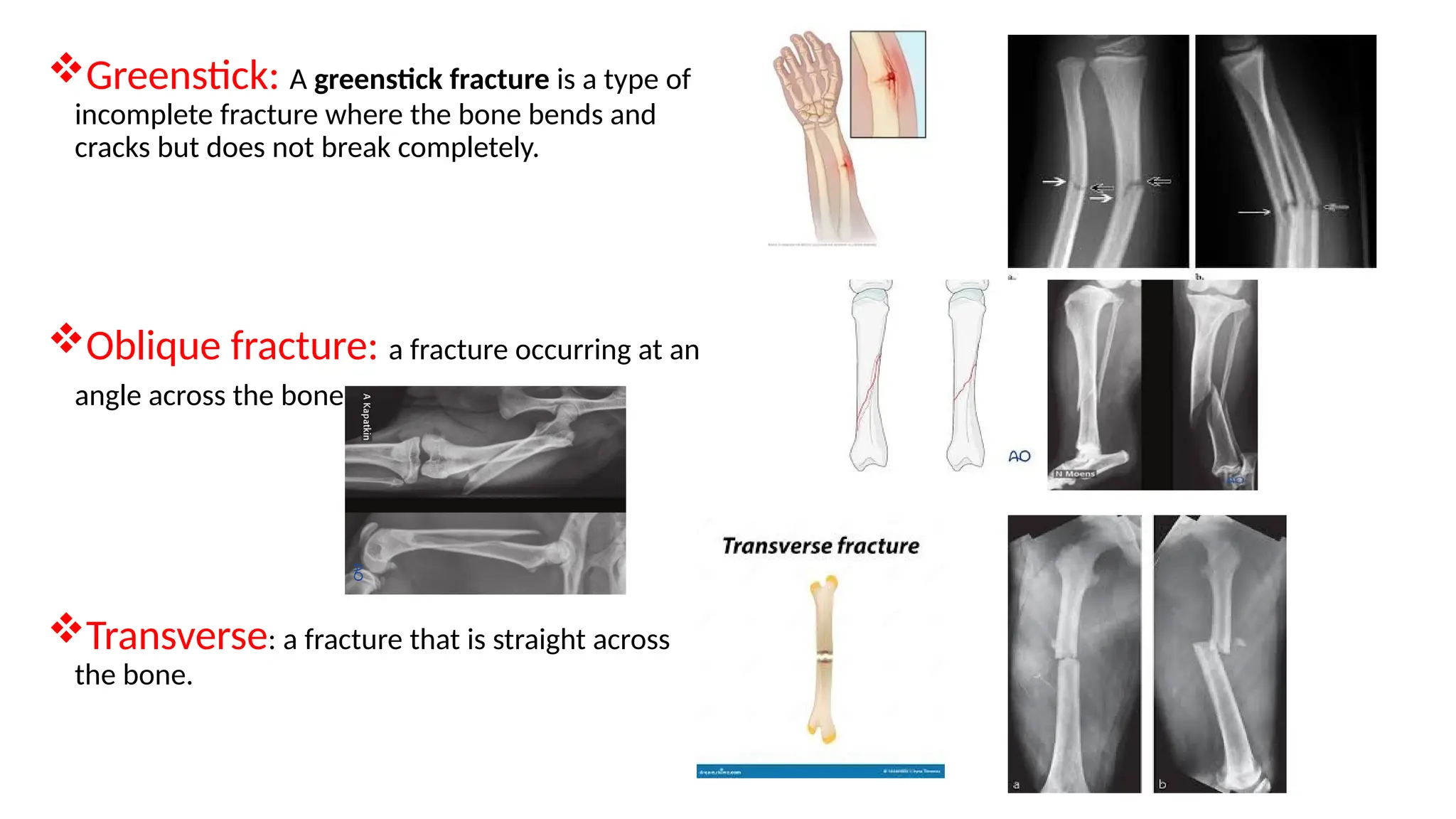 TYPES OF FRACTURES.pptx- shubhashis mondal | PPTX