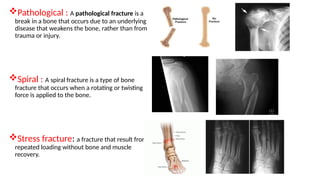 TYPES OF FRACTURES.pptx- shubhashis mondal | PPT