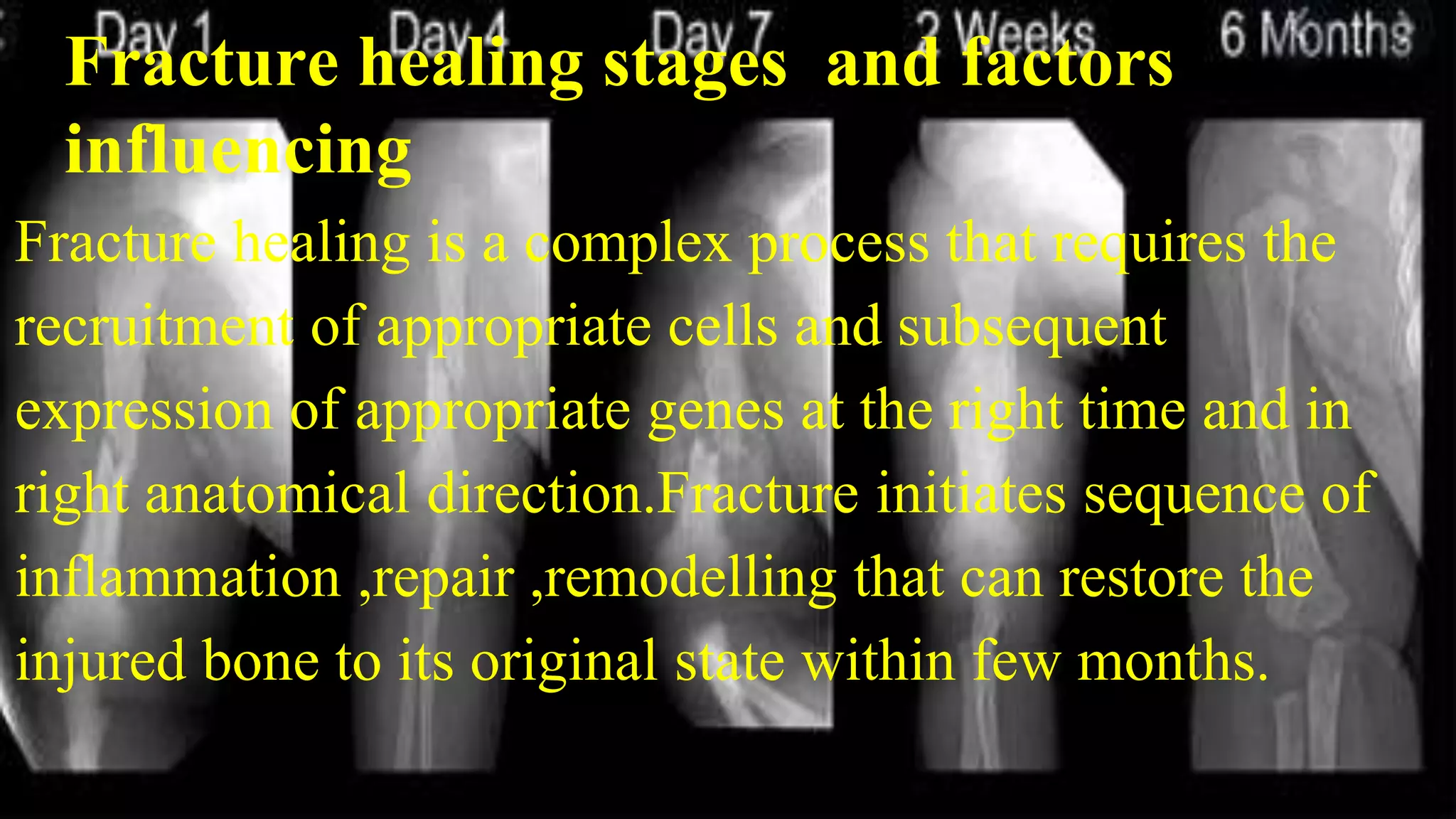 Types of fractures ,fracture healing stages and factors influencing ...
