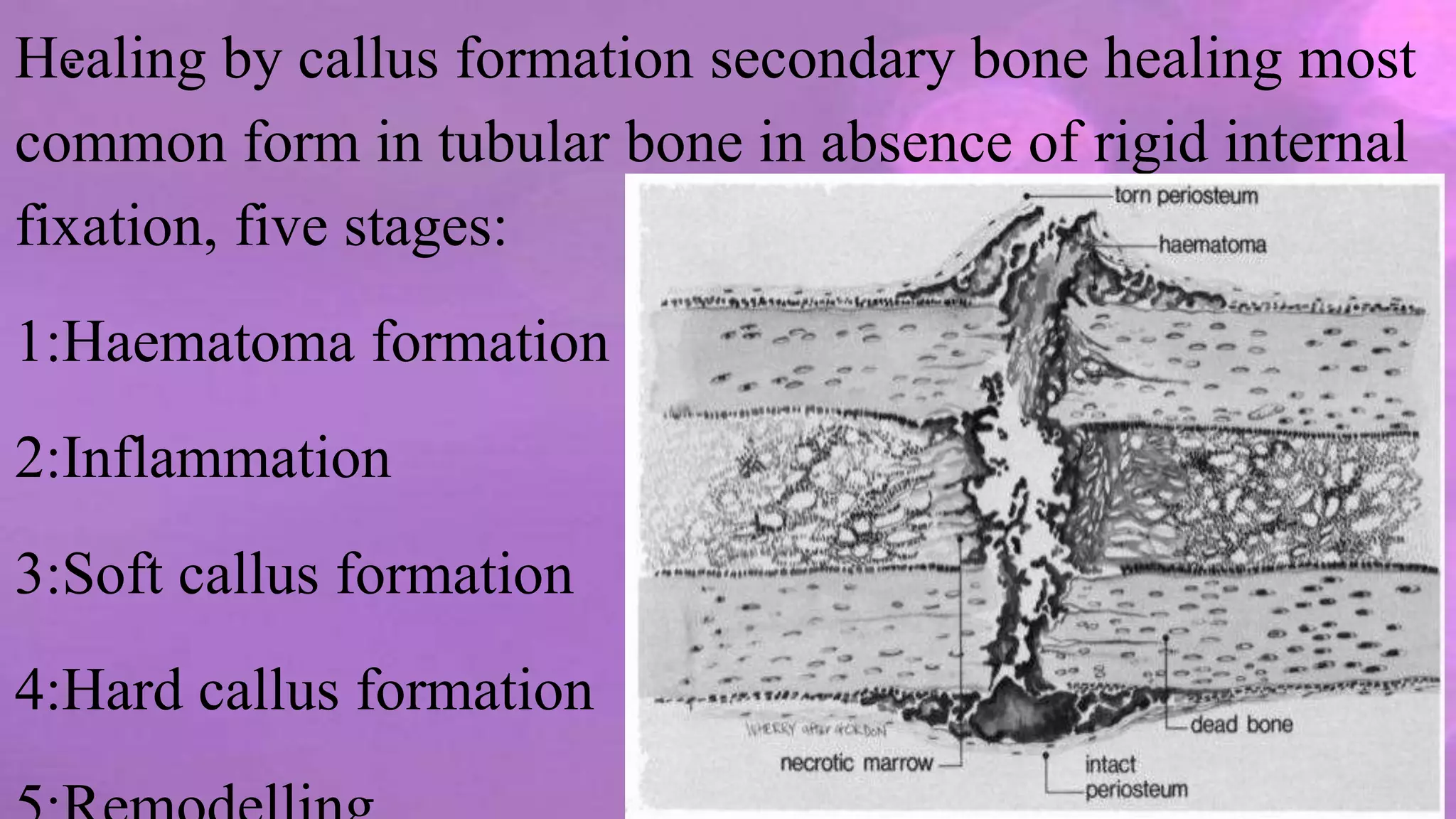 Types of fractures ,fracture healing stages and factors influencing ...