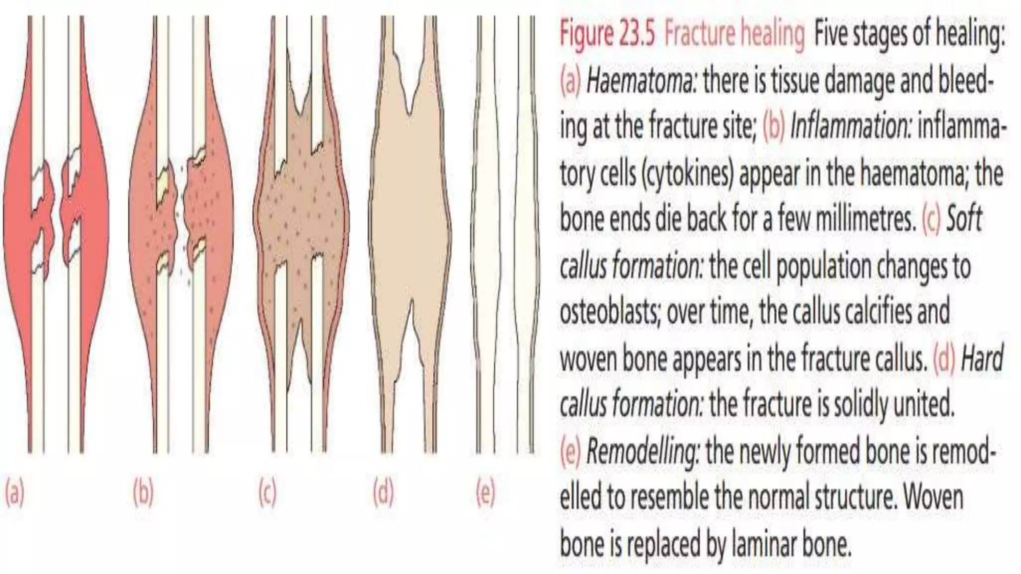 Types of fractures ,fracture healing stages and factors influencing ...